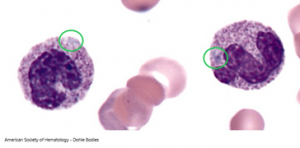 Excite Your Inner Science Nerd - Find RBC & WBC Inclusions! - Med Lab ...