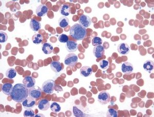 Understanding the BCR-ABL Translocation: The Philadelphia Chromosome ...