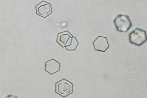 Examining Crystals in Urine Sediment - Med Lab Study Hall