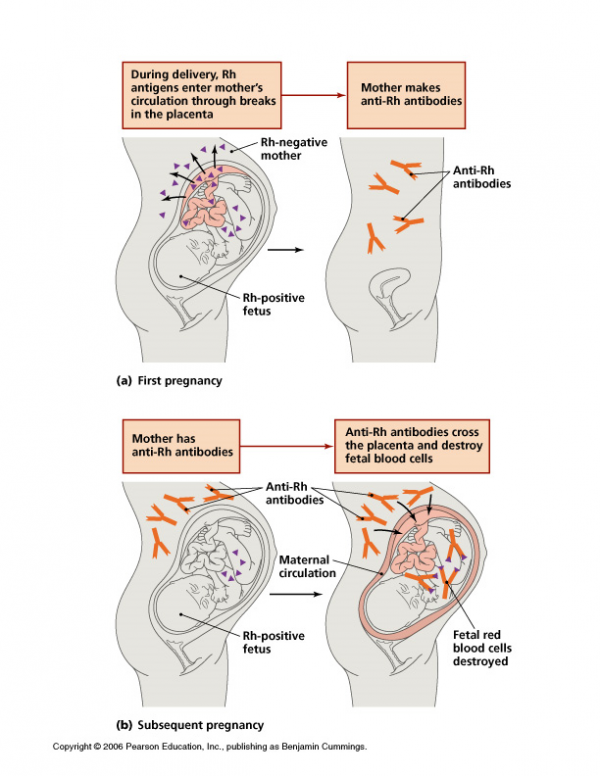 Hemolytic Disease of the Fetus and Newborn (HDFN) - Med Lab Study Hall